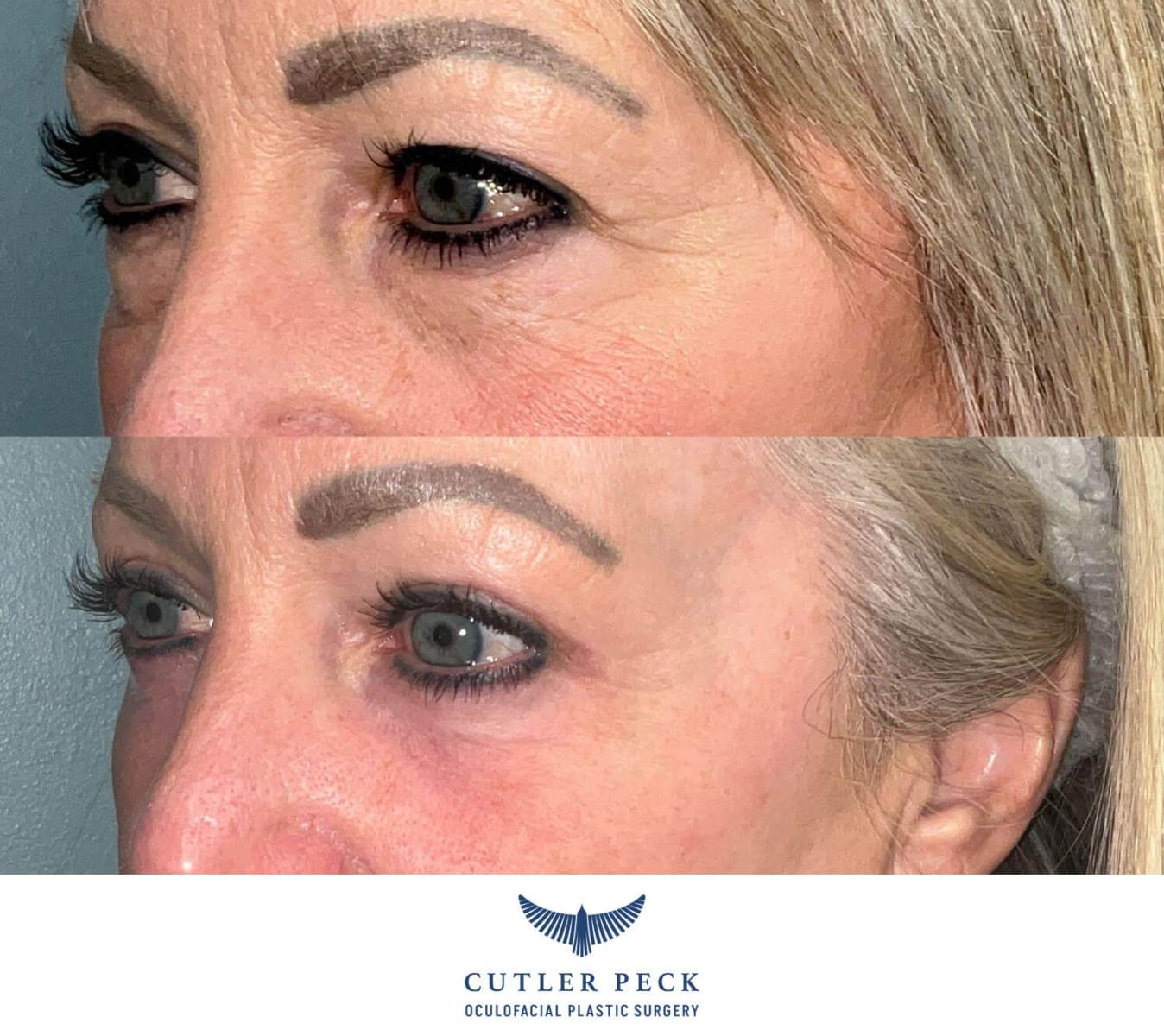 Female Bilateral Lower Eyelid Blepharoplasty | Dr. Cutler Peck