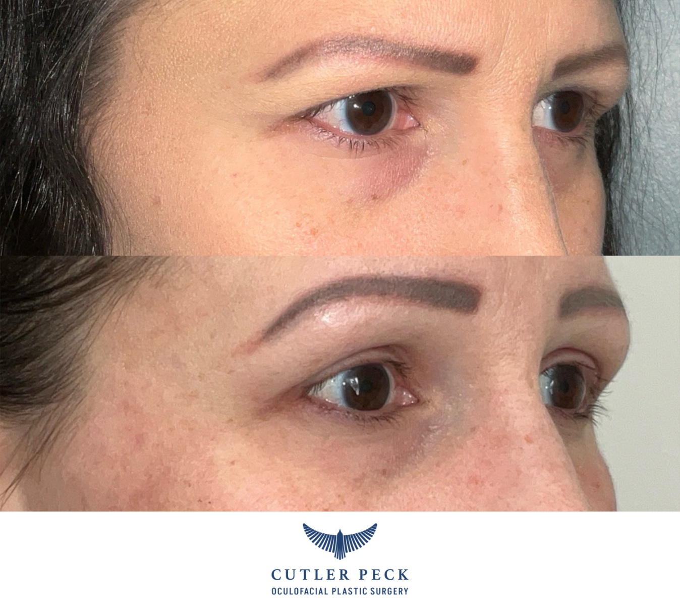 Female Bilateral Upper Eyelid Blepharoplasty | Dr. Cutler Peck