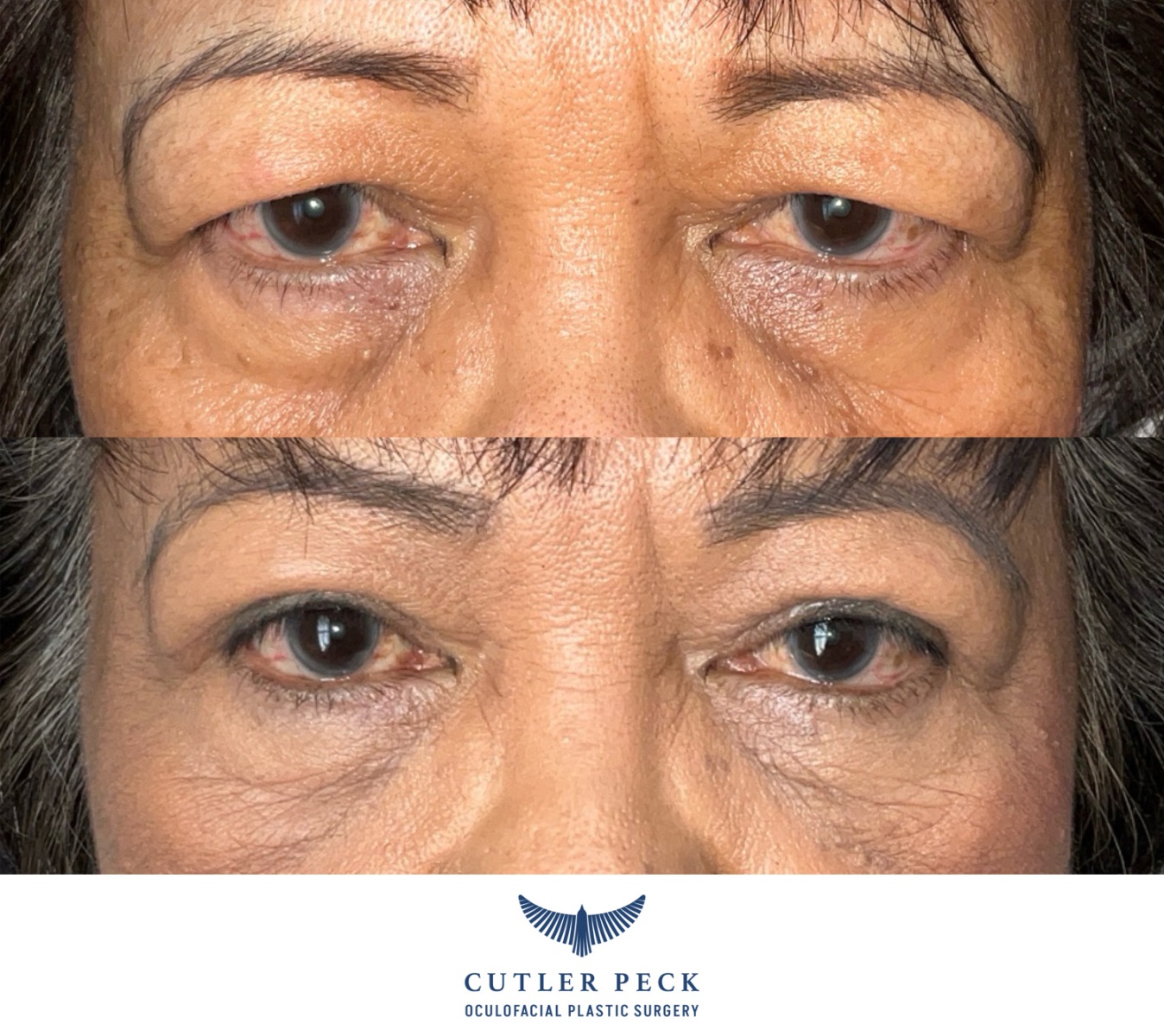 Female Bilateral Upper Eyelid Blepharoplasty | Dr. Cutler Peck