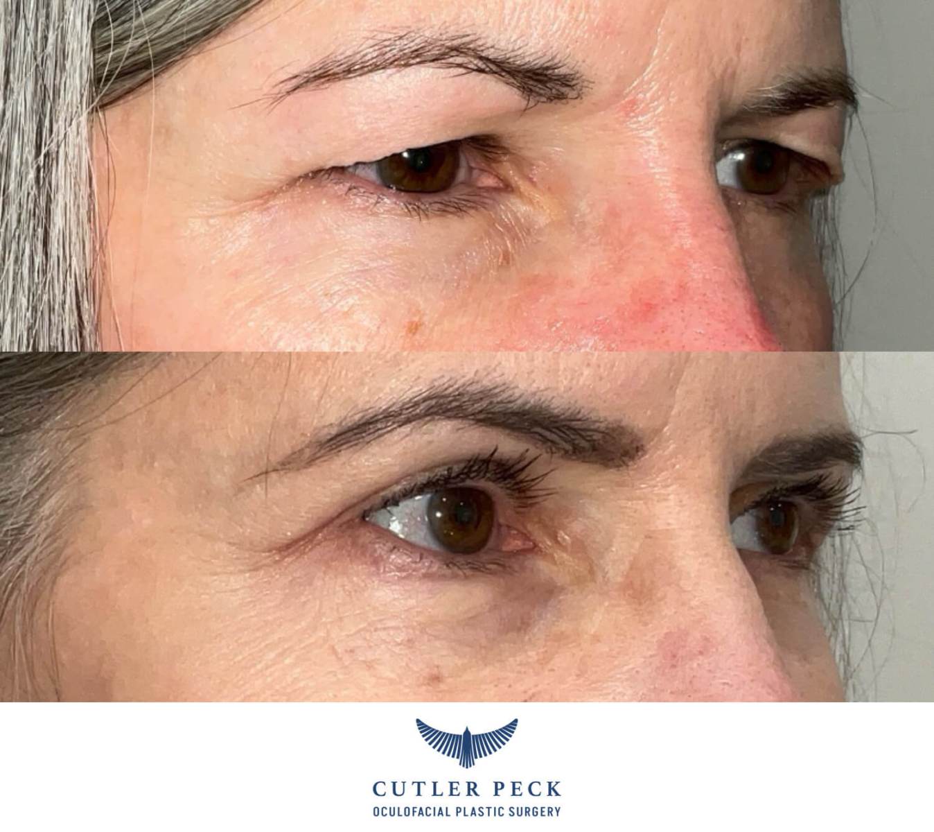 Female Bilateral Upper Eyelid Blepharoplasty | Dr. Cutler Peck