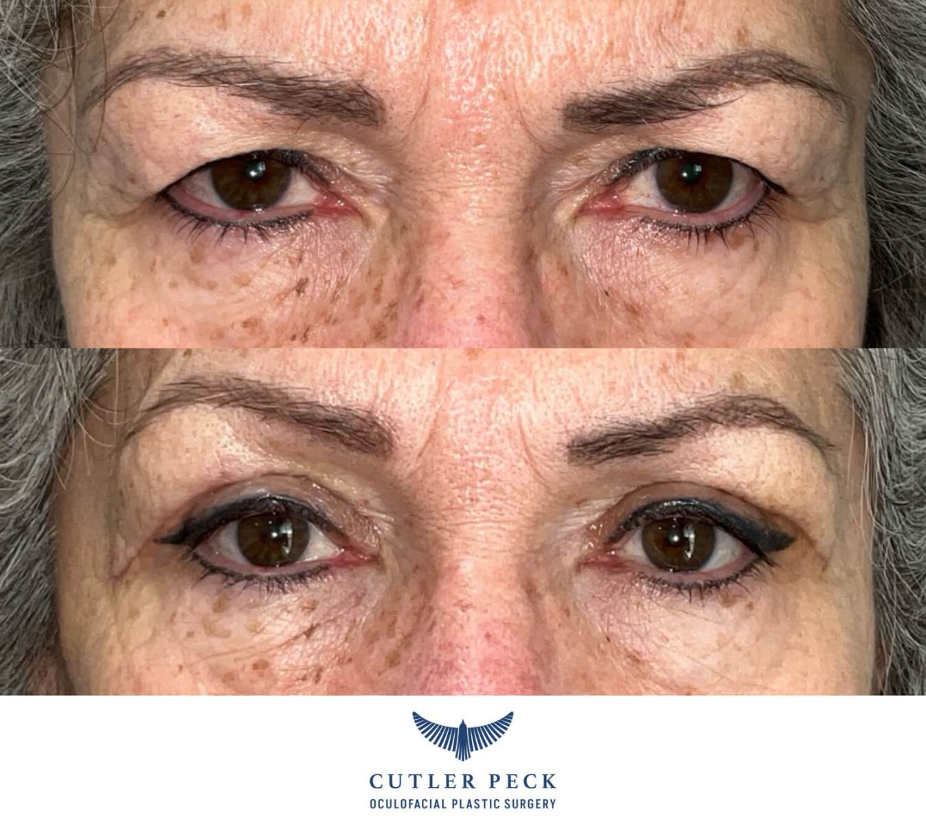 Female Bilateral Upper Eyelid Blepharoplasty | Dr. Cutler Peck