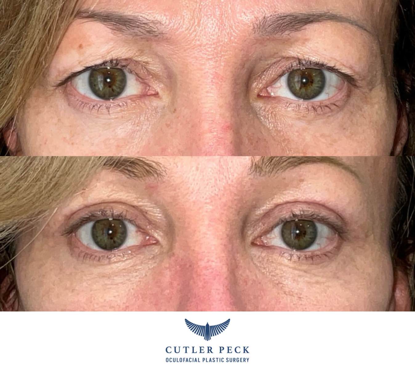 Female Bilateral Upper Eyelid Blepharoplasty | Dr. Cutler Peck