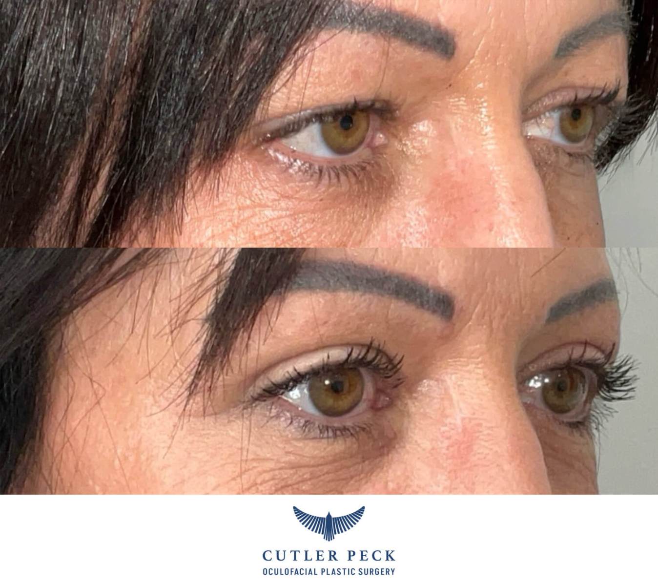 Female Bilateral Upper Eyelid Blepharoplasty | Dr. Cutler Peck