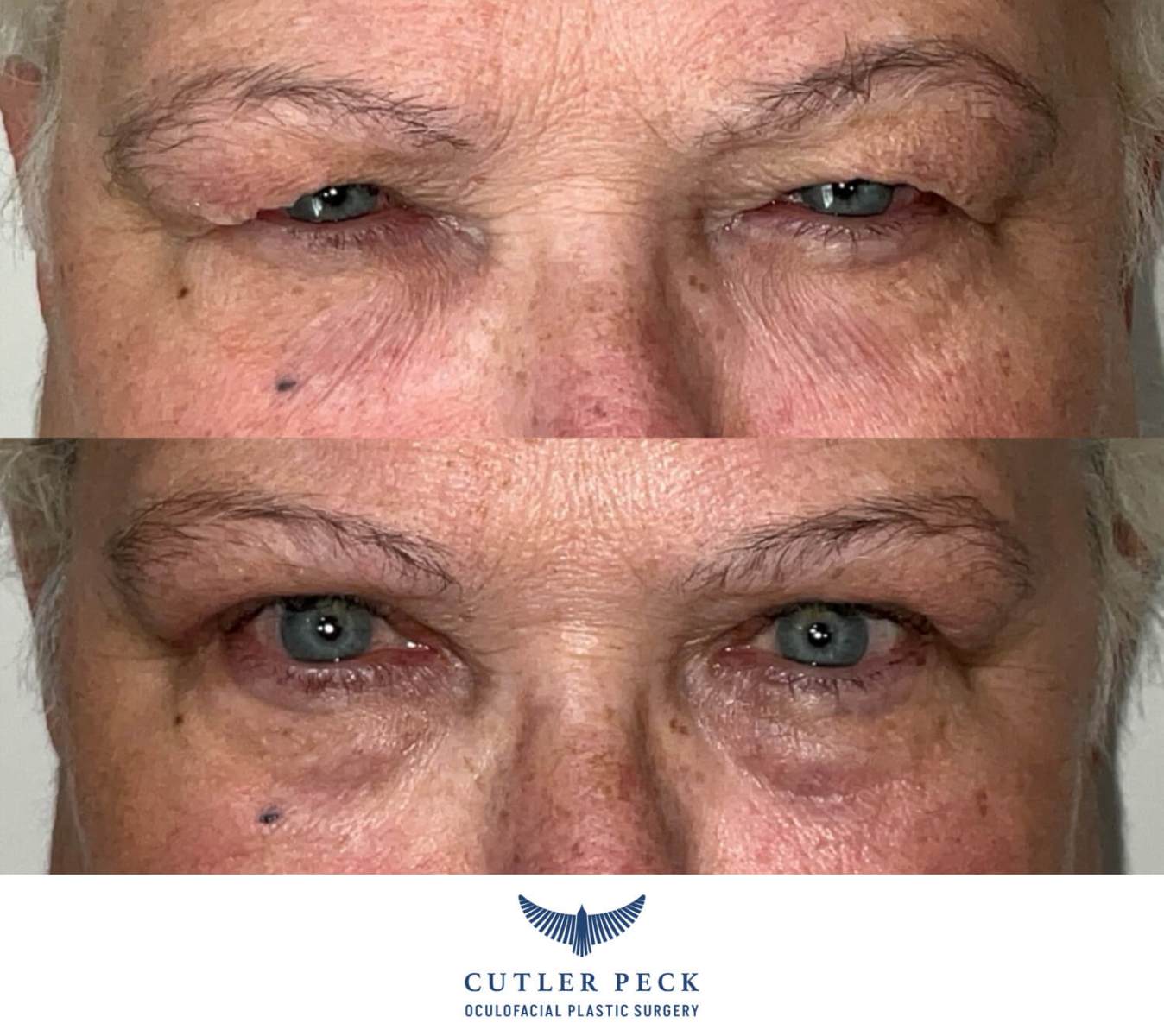 Female Bilateral Upper Eyelid Blepharoplasty | Dr. Cutler Peck
