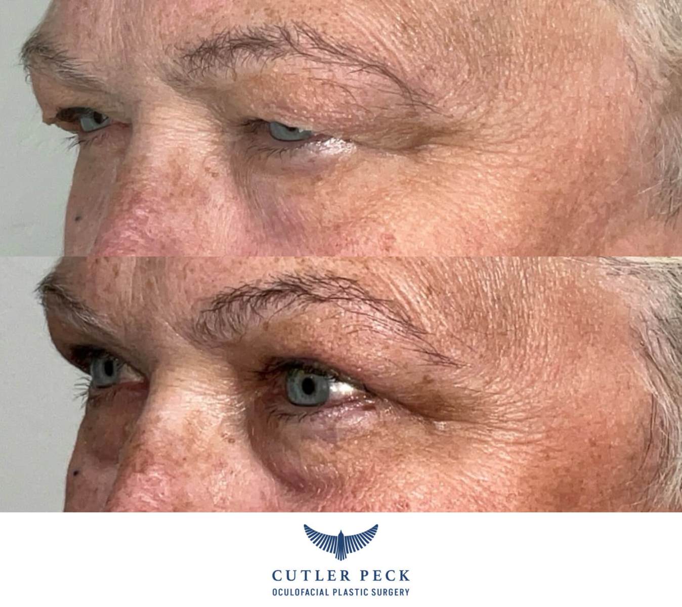 Female Bilateral Upper Eyelid Blepharoplasty | Dr. Cutler Peck