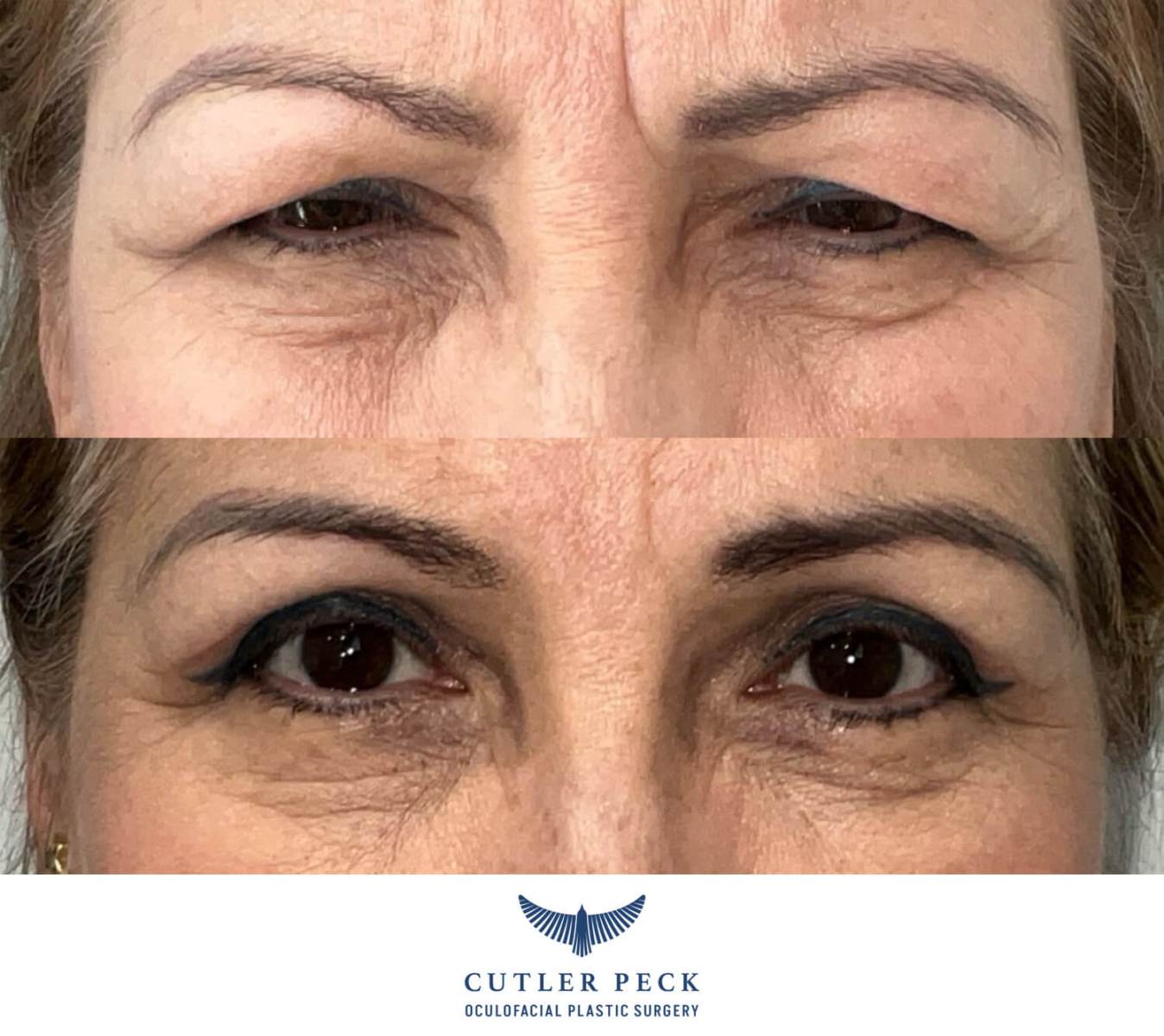 Female Bilateral Upper Eyelid Blepharoplasty | Dr. Cutler Peck