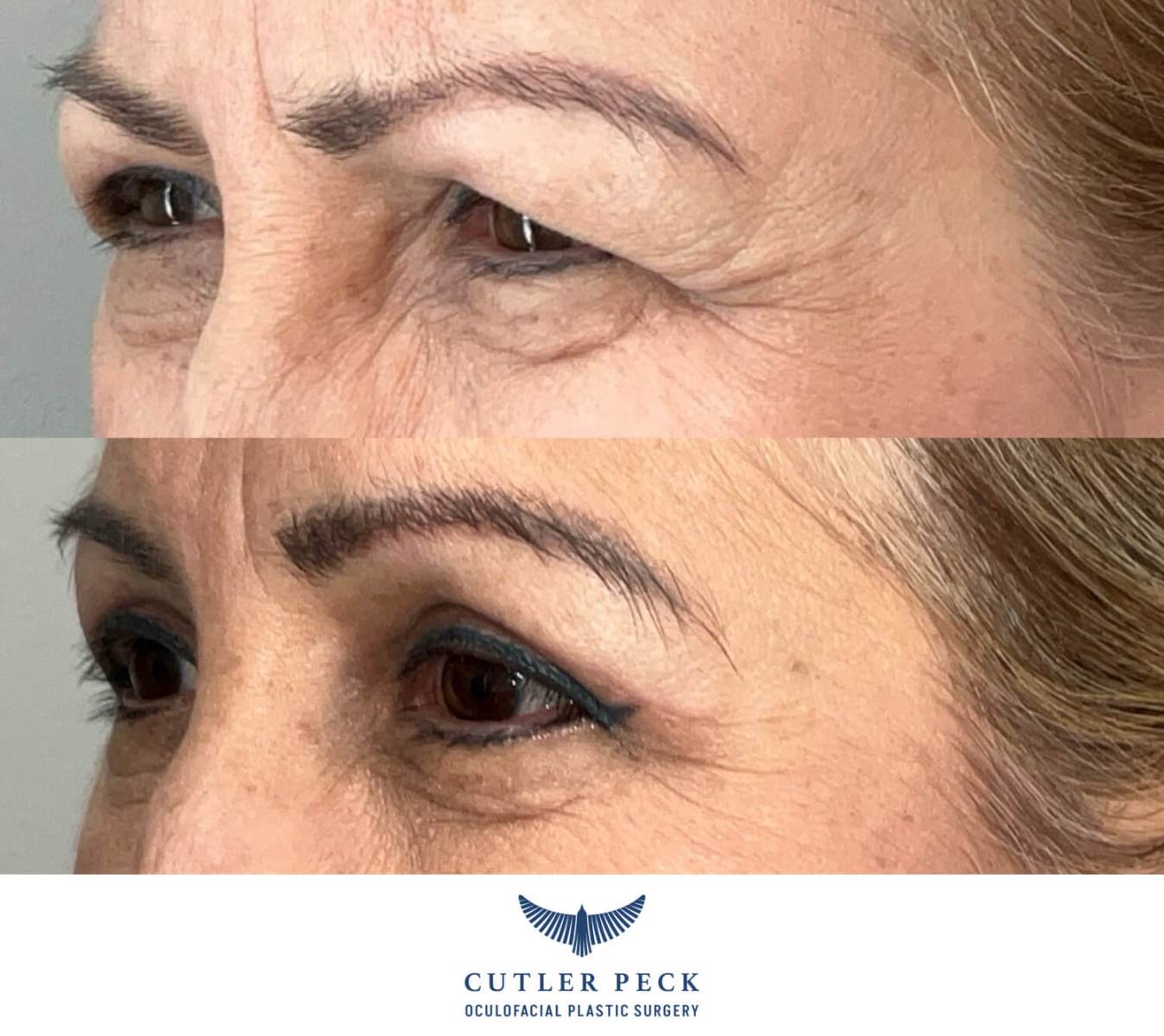 Female Bilateral Upper Eyelid Blepharoplasty | Dr. Cutler Peck