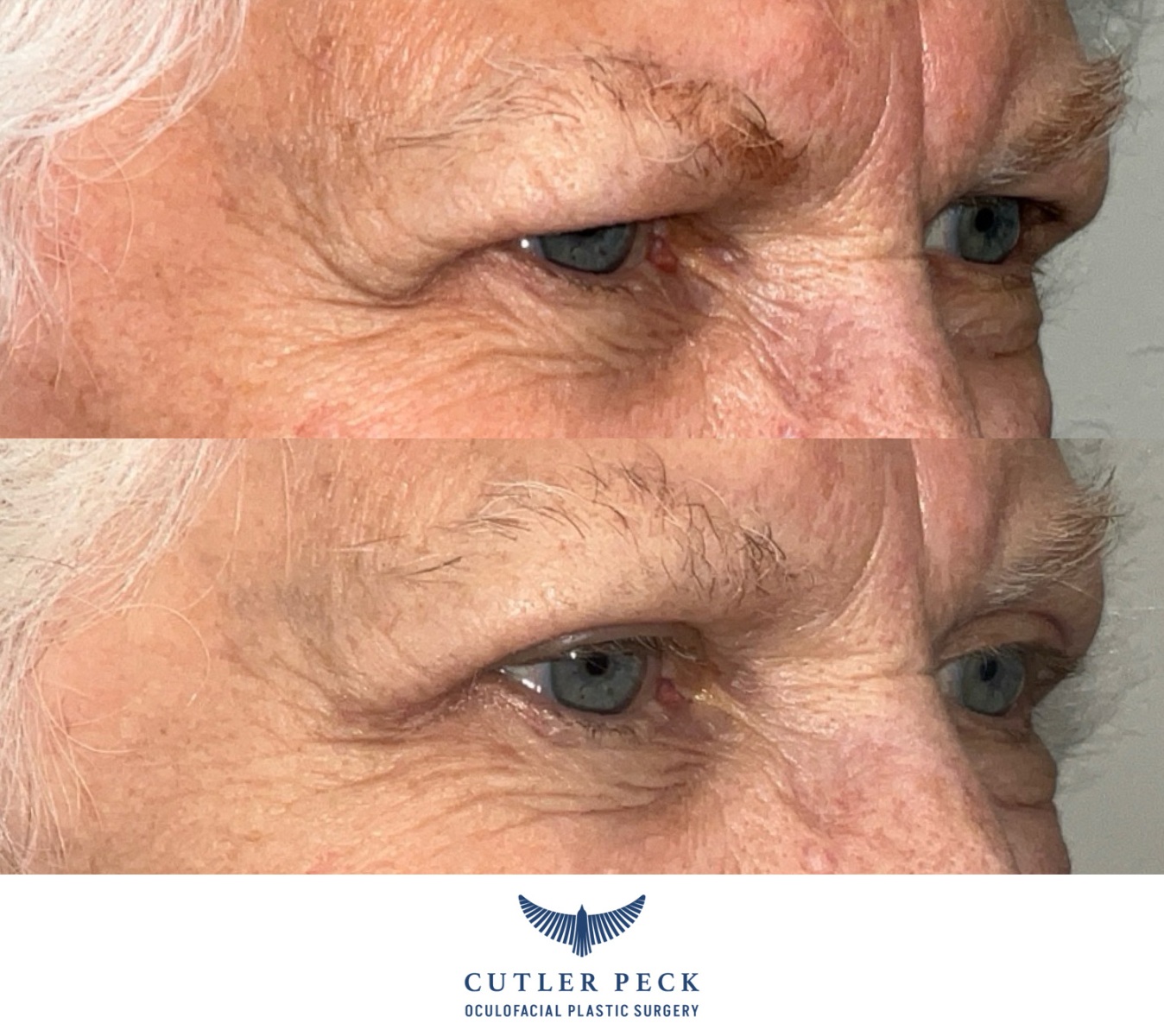Female Bilateral Upper Eyelid Blepharoplasty | Dr. Cutler Peck