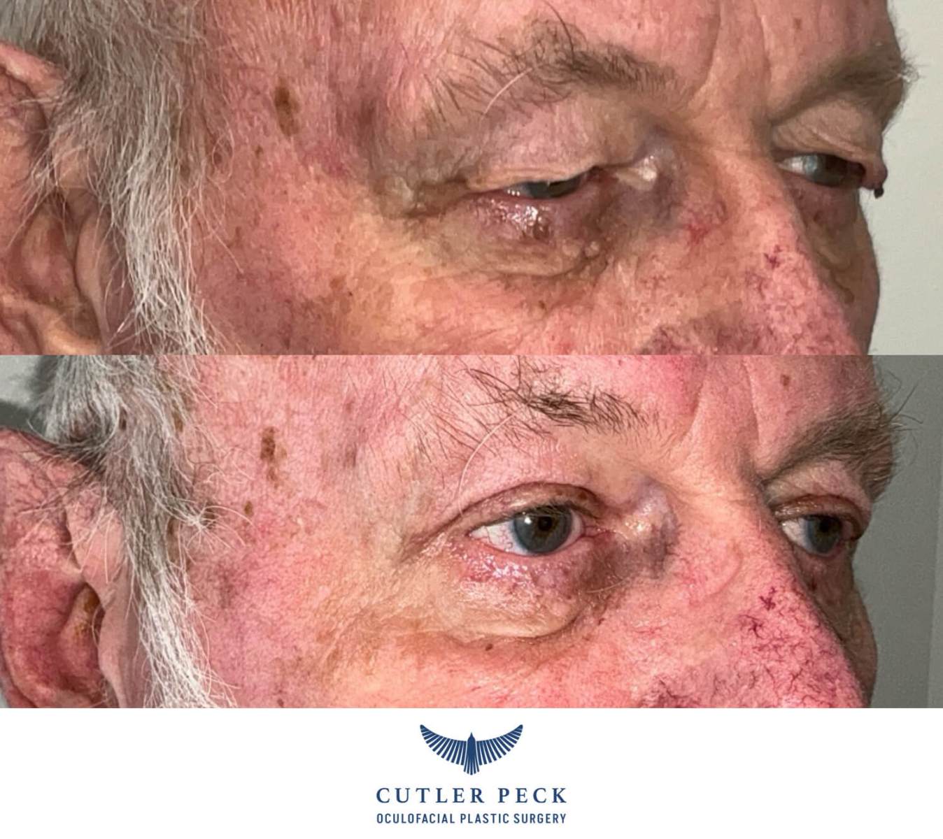 Male Bilateral Upper Eyelid Blepharoplasty | Dr. Cutler Peck