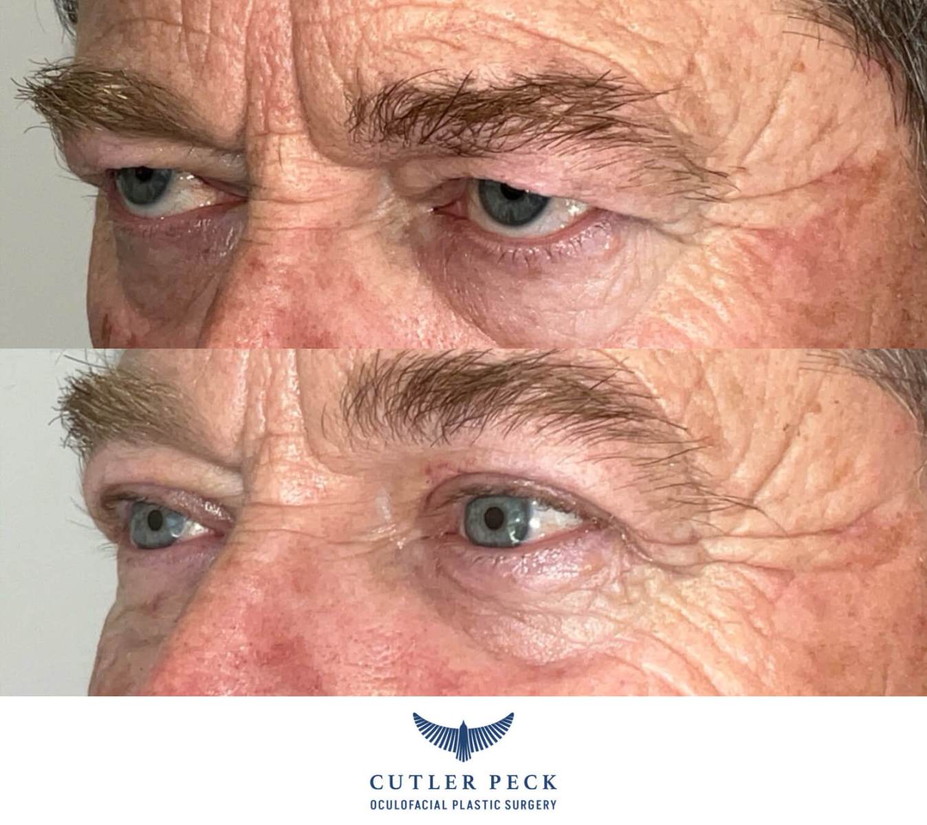 Male Bilateral Upper Eyelid Blepharoplasty | Dr. Cutler Peck