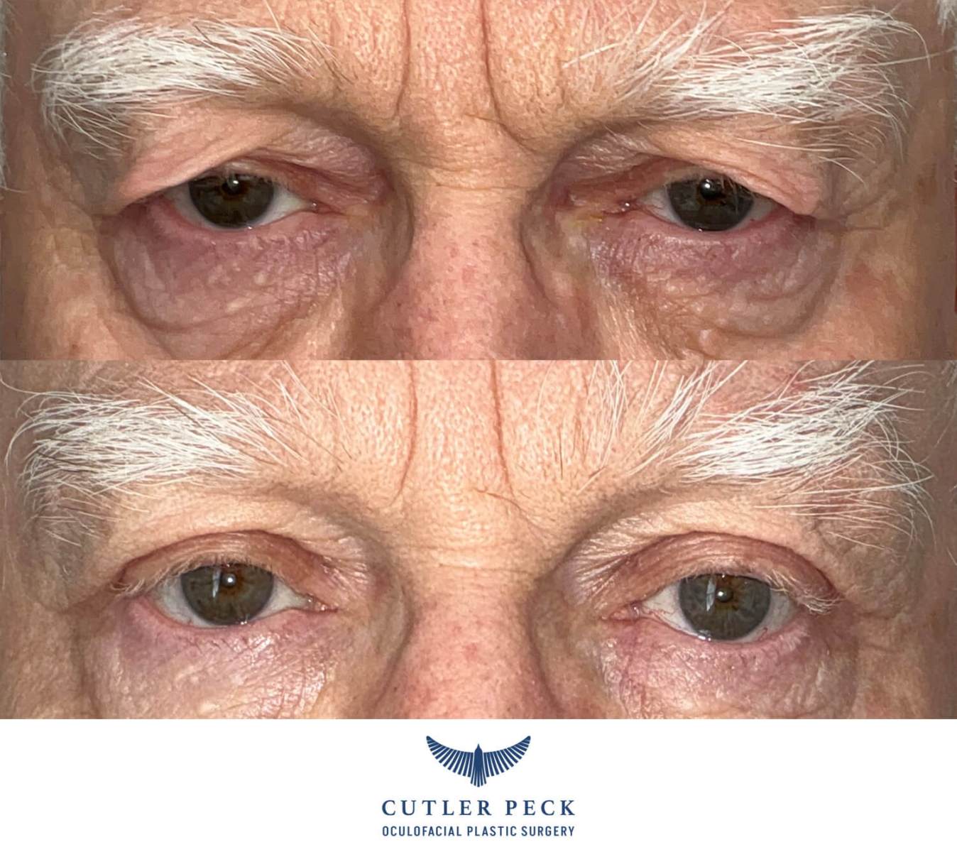 Male Bilateral Upper Eyelid Blepharoplasty | Dr. Cutler Peck