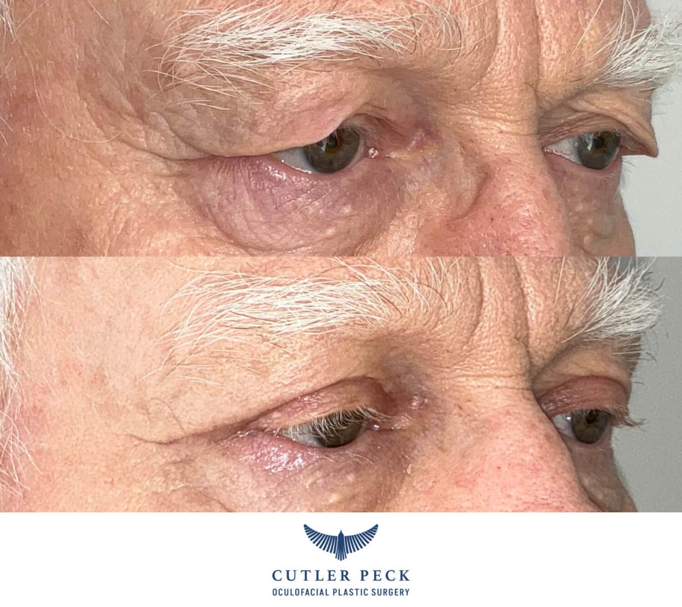 Male Bilateral Upper Eyelid Blepharoplasty | Dr. Cutler Peck