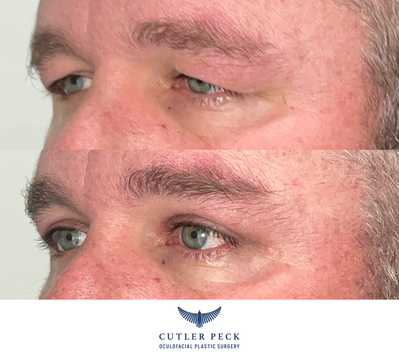 Male Bilateral Upper Eyelid Blepharoplasty | Dr. Cutler Peck