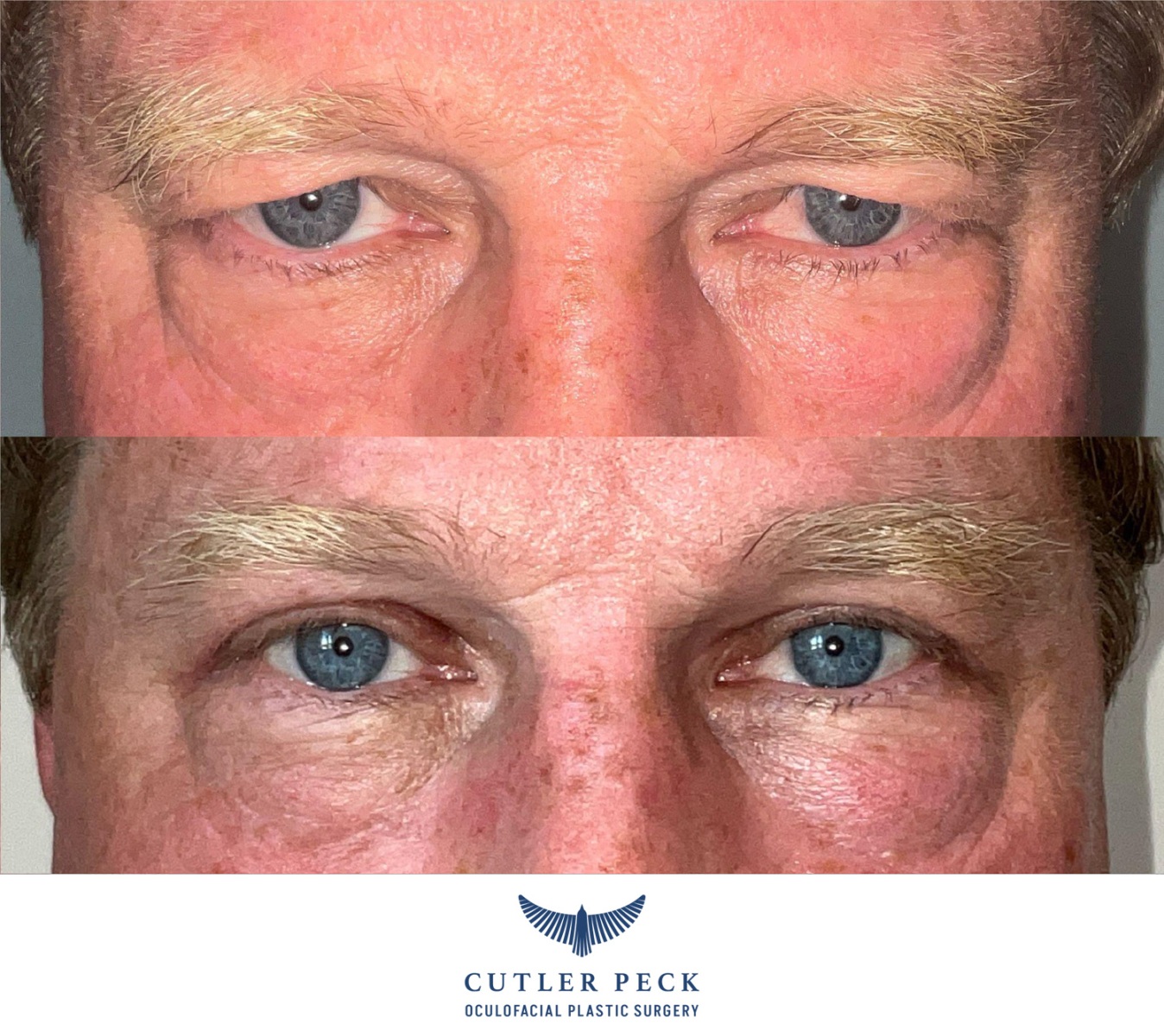 Male Bilateral Upper Eyelid Blepharoplasty | Dr. Cutler Peck