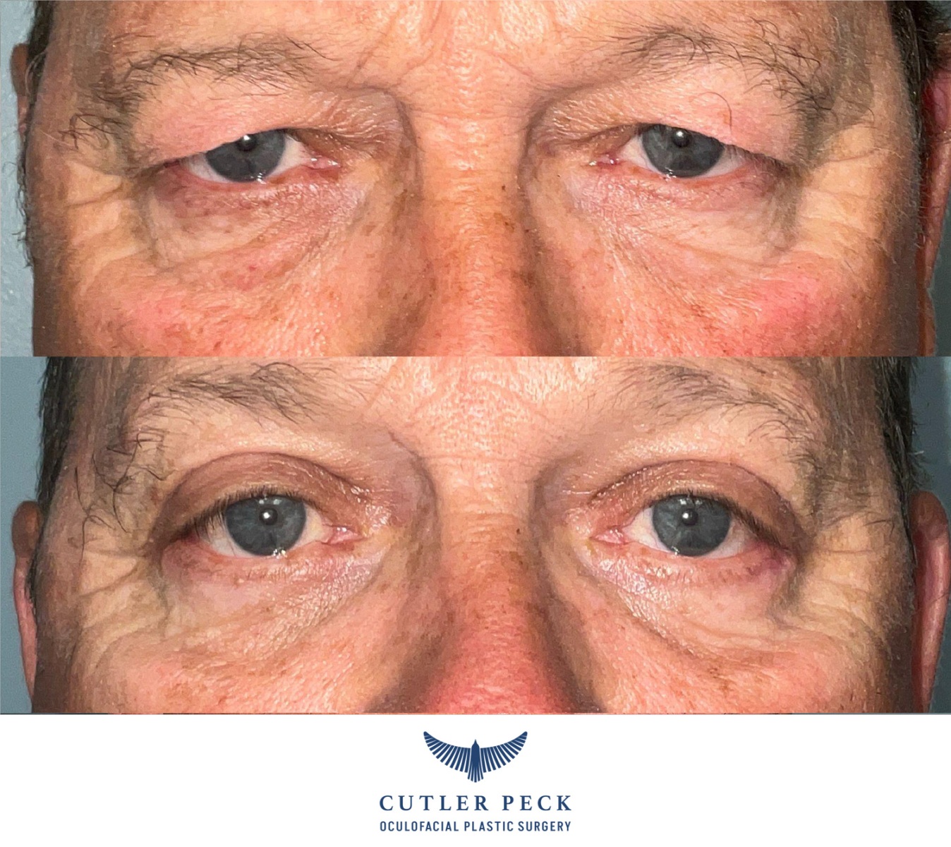 Male Bilateral Upper Eyelid Blepharoplasty | Dr. Cutler Peck