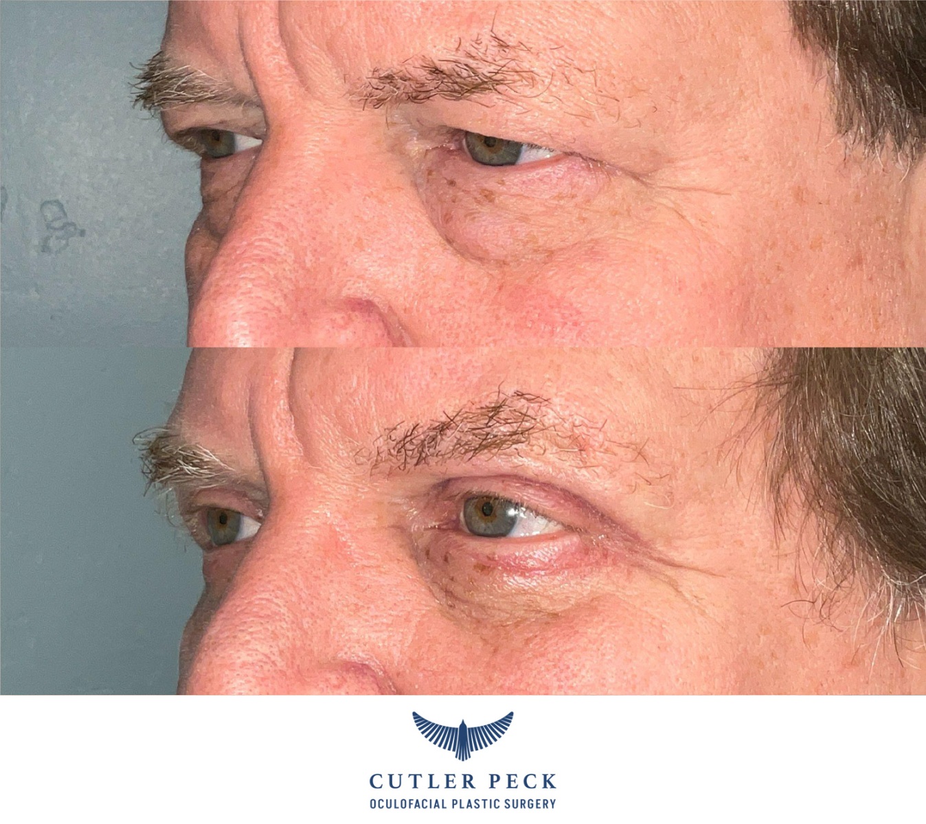 Male Bilateral Upper Eyelid Blepharoplasty | Dr. Cutler Peck