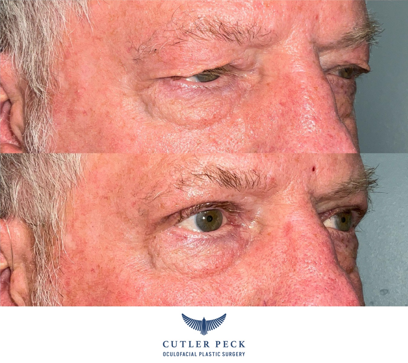 Male Bilateral Upper Eyelid Blepharoplasty | Dr. Cutler Peck