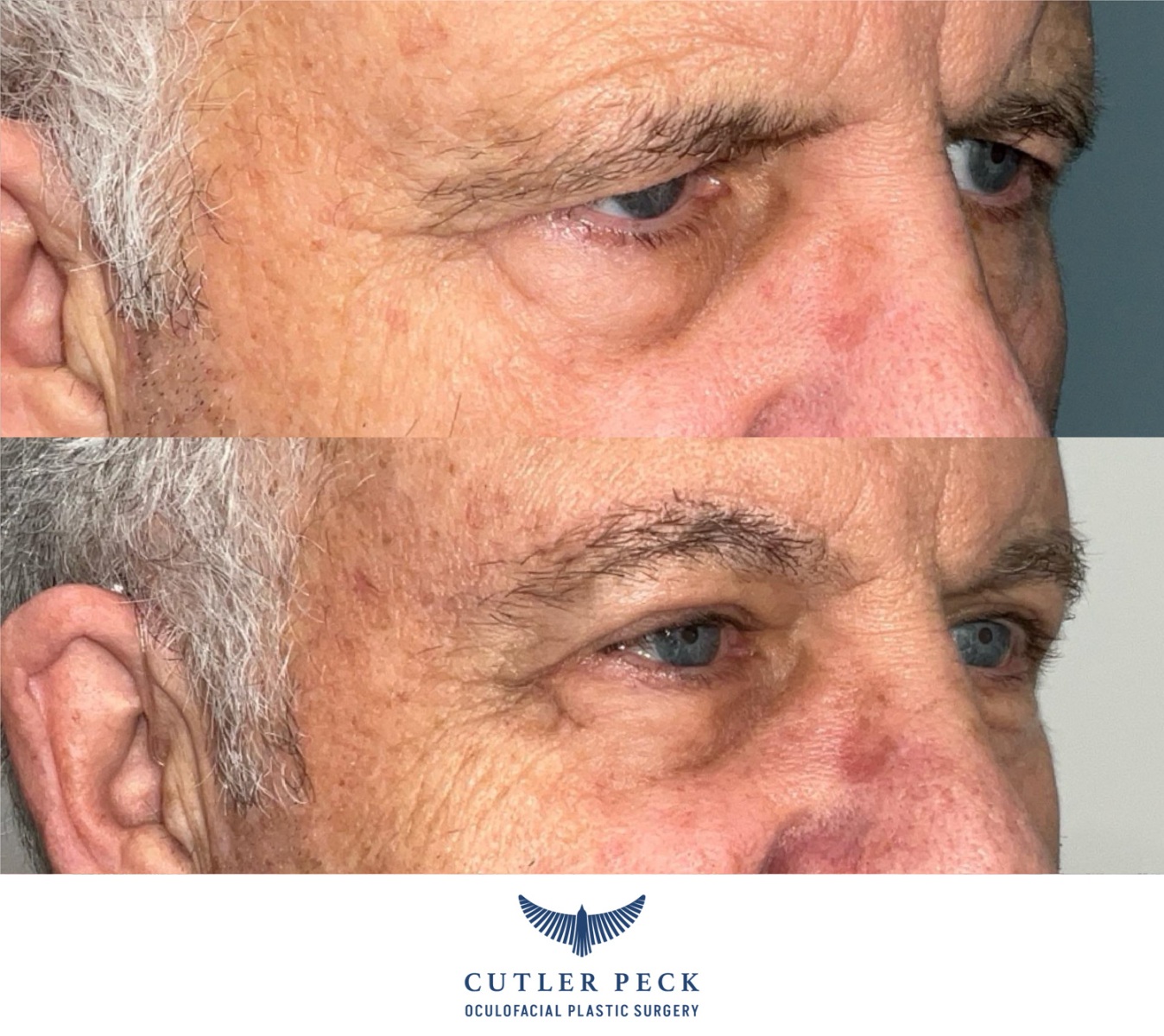 Male Bilateral Upper Eyelid Blepharoplasty | Dr. Cutler Peck