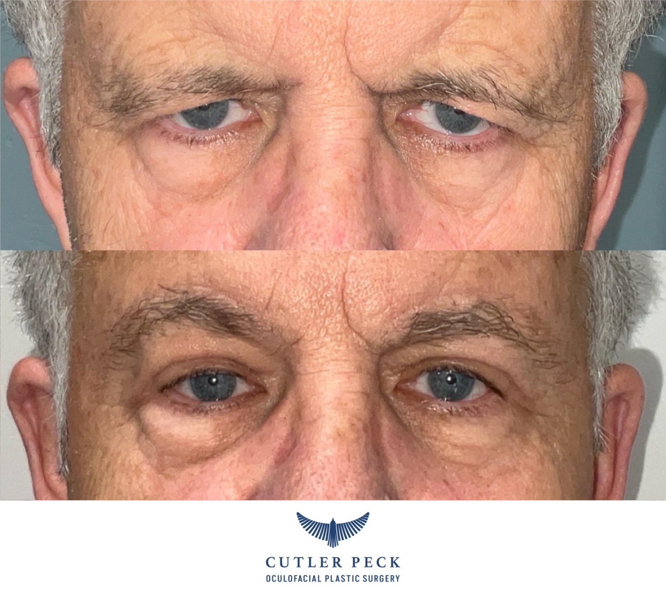 Male Bilateral Upper Eyelid Blepharoplasty | Dr. Cutler Peck