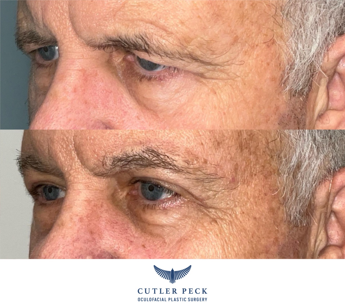 Male Bilateral Upper Eyelid Blepharoplasty | Dr. Cutler Peck