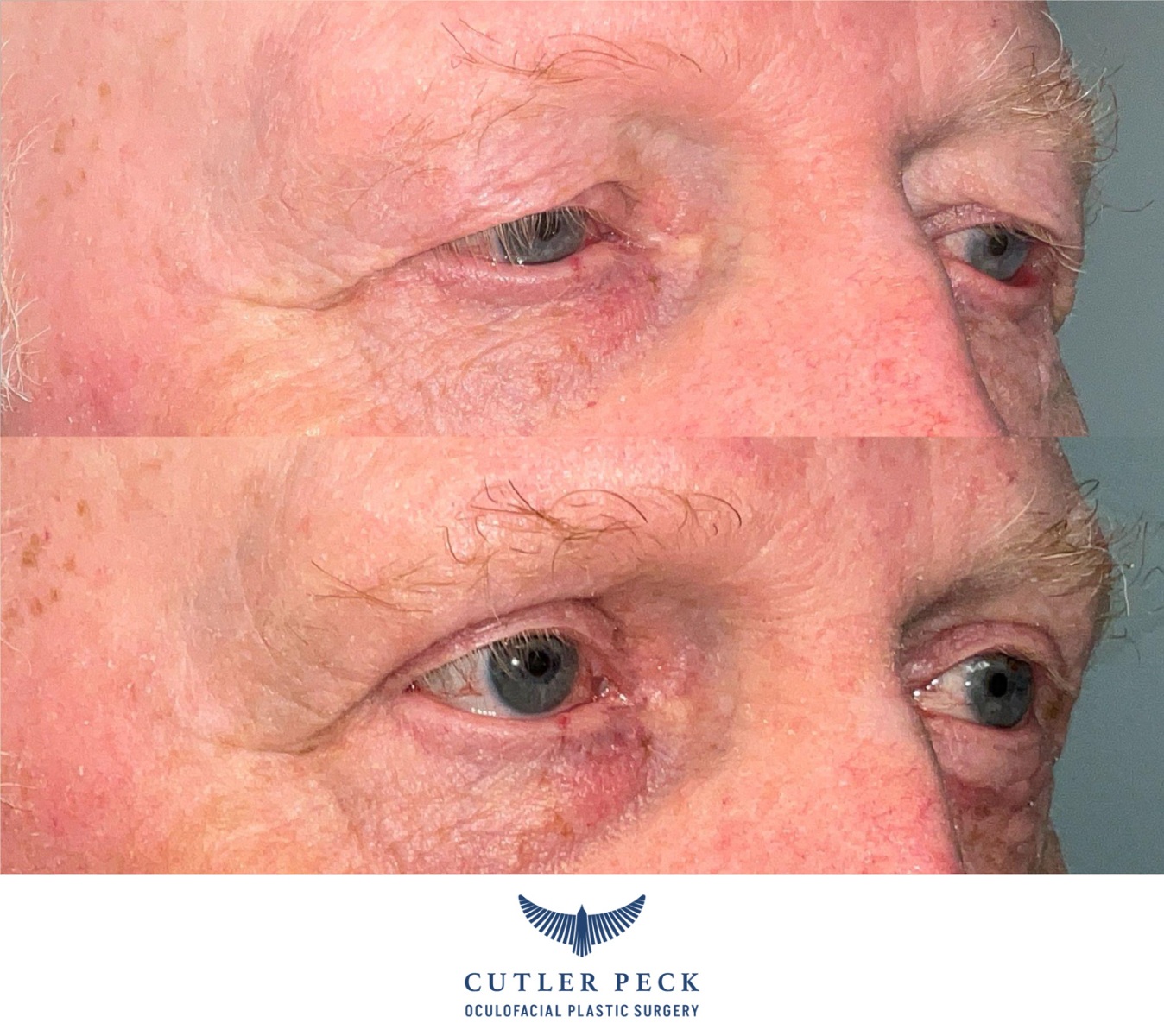 Male Bilateral Upper Eyelid Blepharoplasty | Dr. Cutler Peck