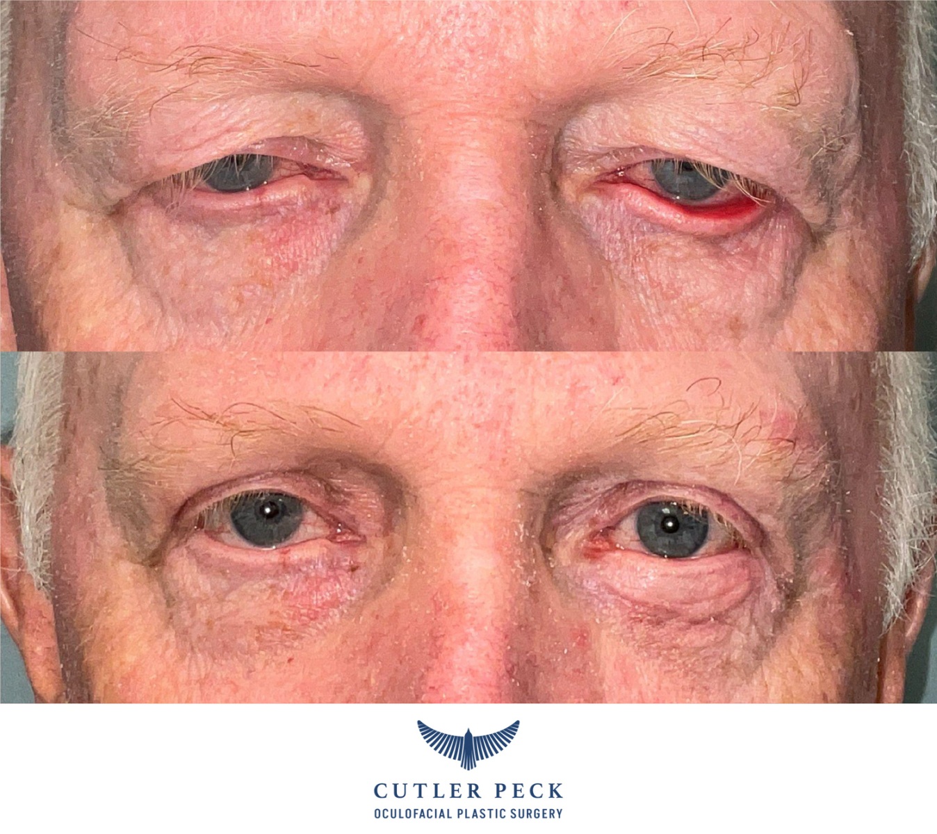 Male Bilateral Upper Eyelid Blepharoplasty | Dr. Cutler Peck