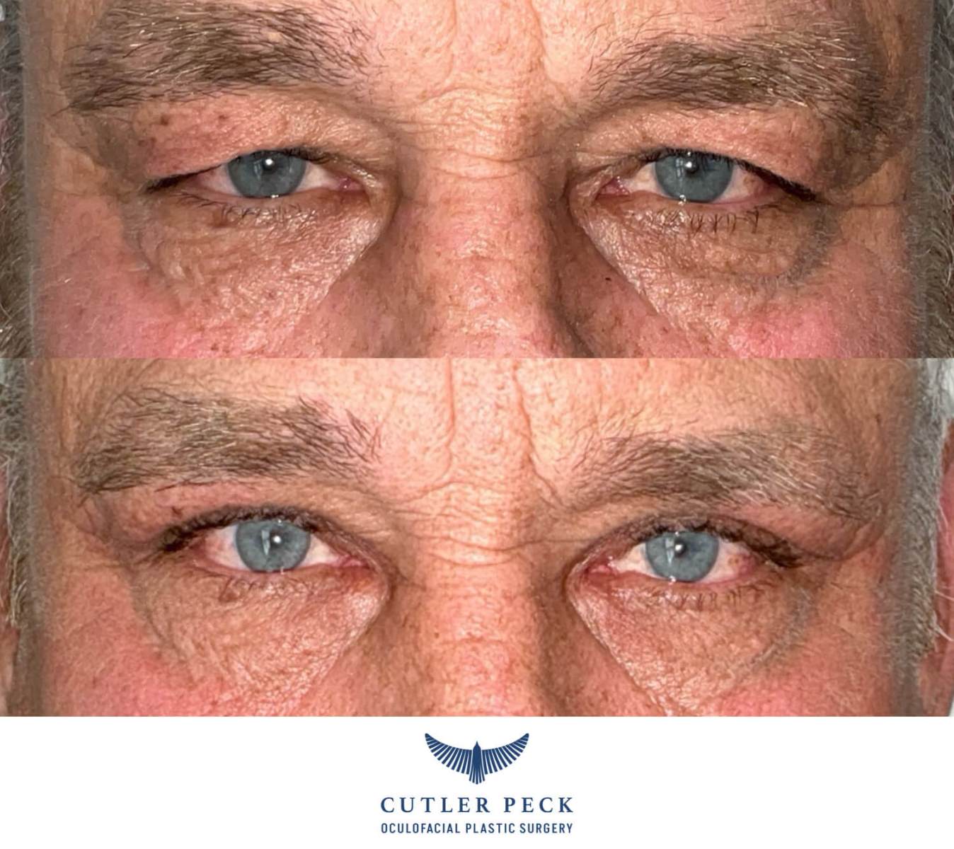 Male Bilateral Upper Eyelid Blepharoplasty | Dr. Cutler Peck