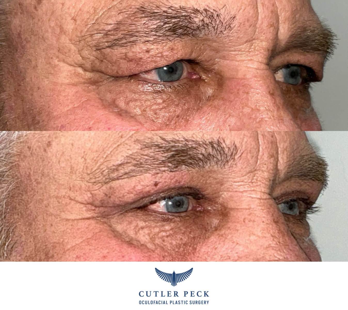 Male Bilateral Upper Eyelid Blepharoplasty | Dr. Cutler Peck
