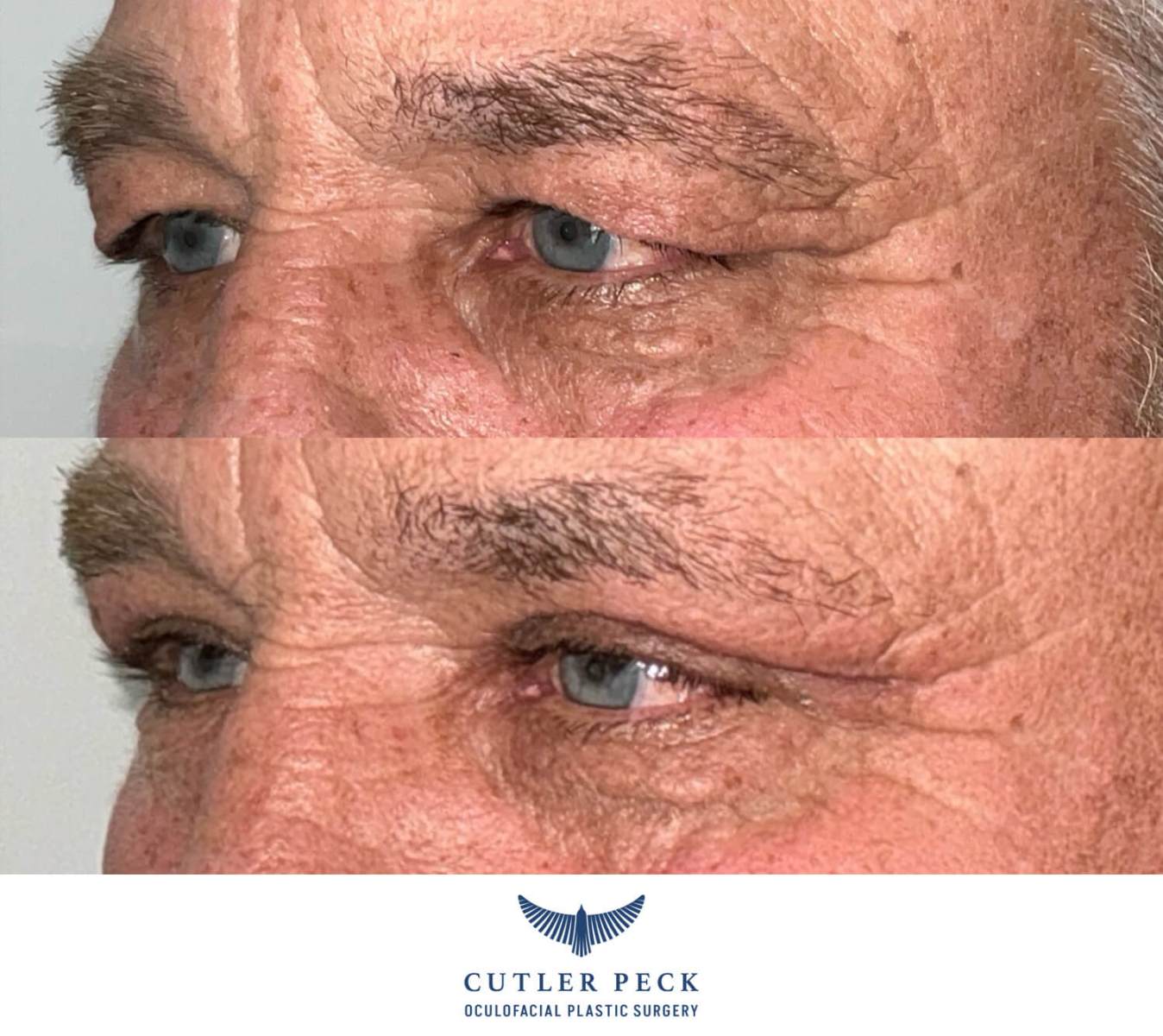 Male Bilateral Upper Eyelid Blepharoplasty | Dr. Cutler Peck