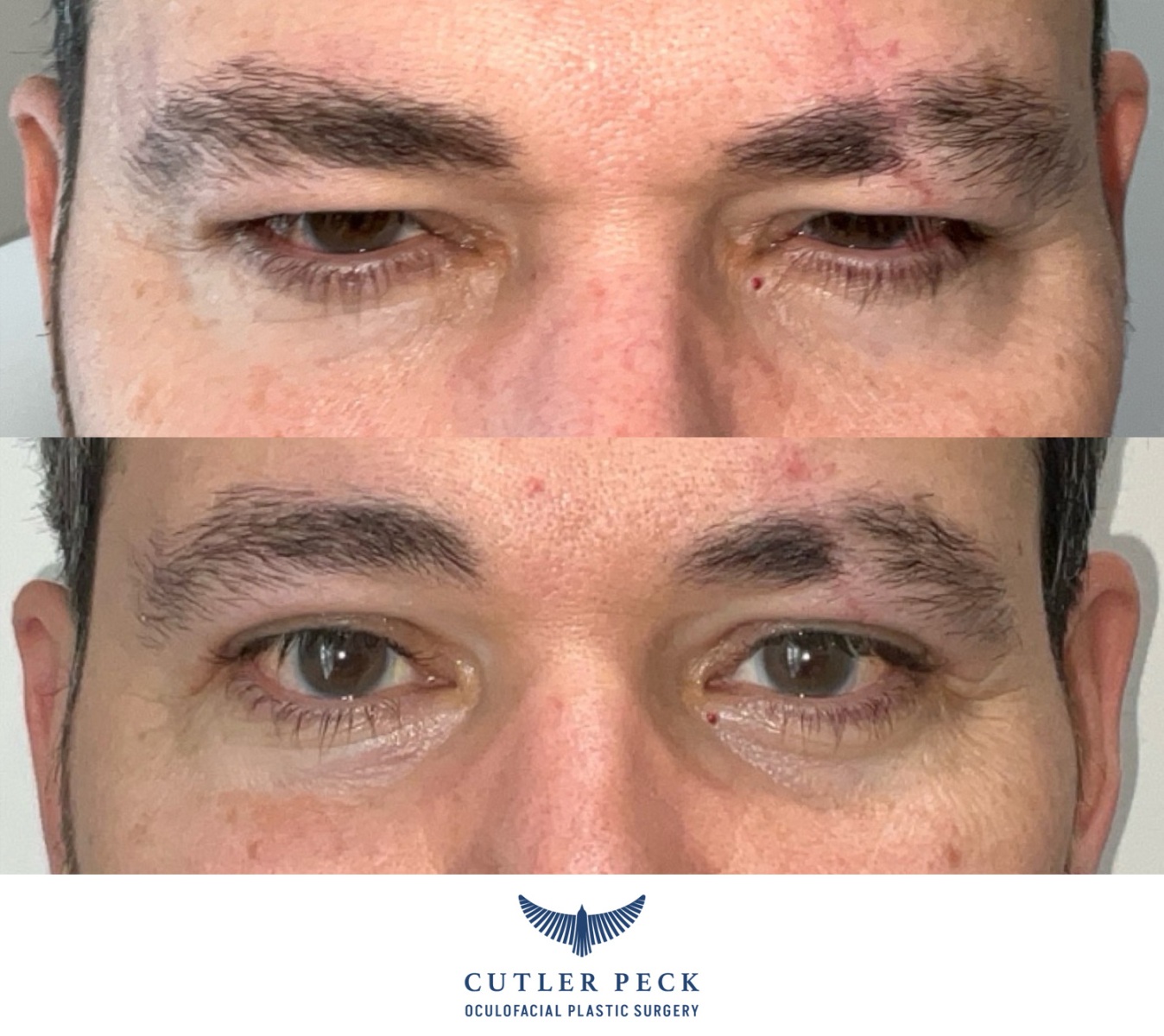 Male Bilateral Upper Eyelid Blepharoplasty | Dr. Cutler Peck