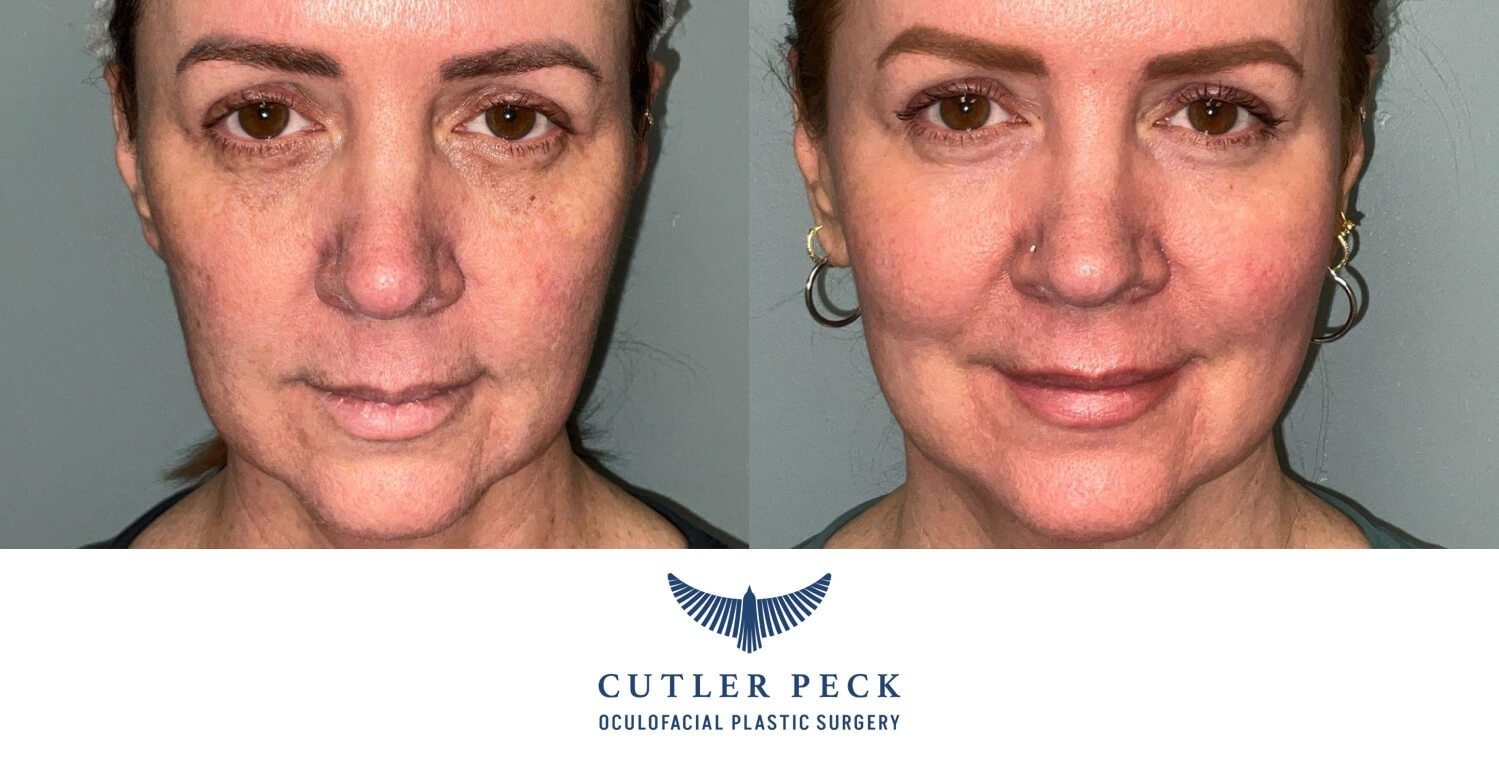 UltraClear Laser | Dr. Cutler Peck
