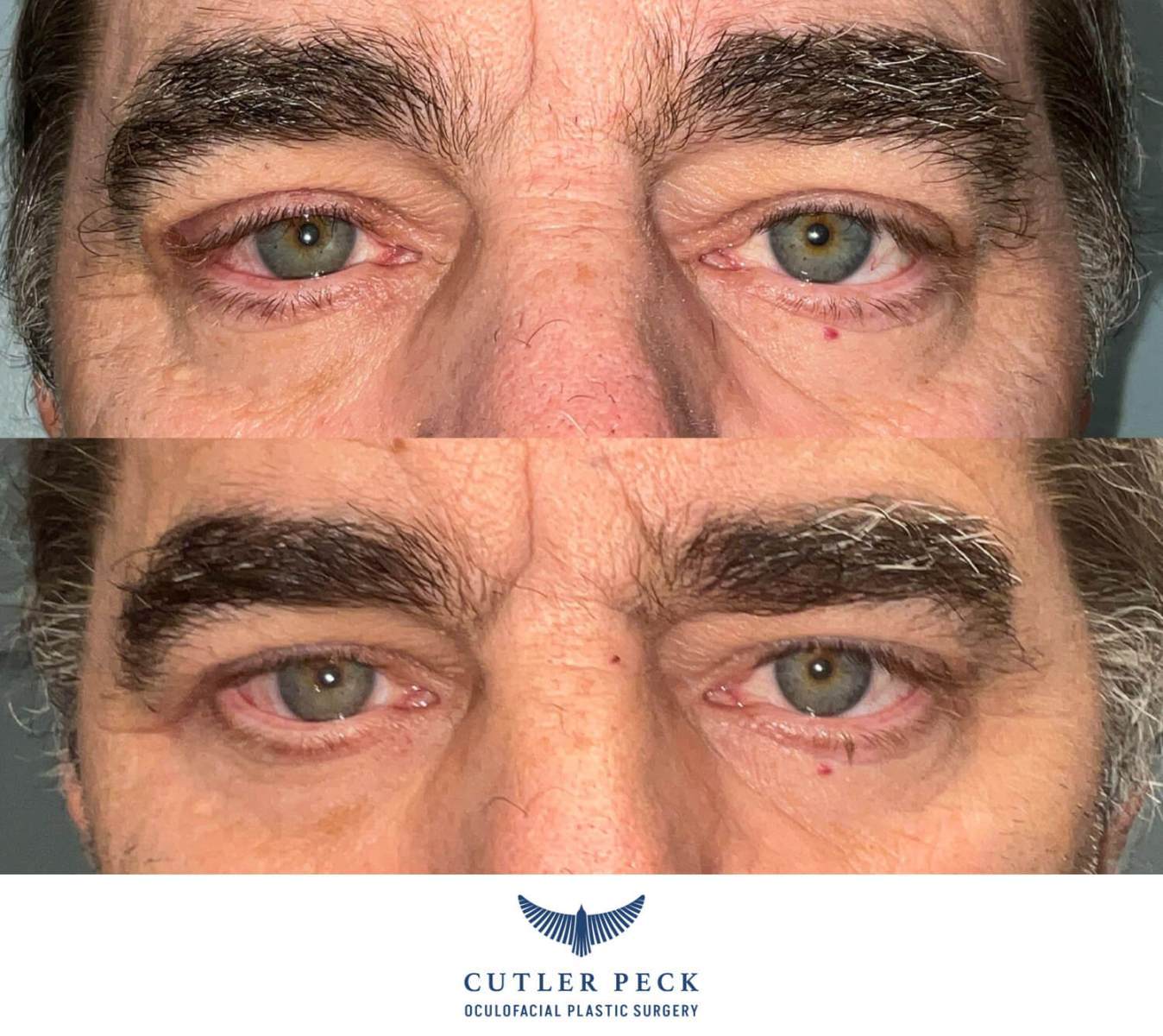 Eyelid Skin Cancer Surgery | Dr. Cutler Peck