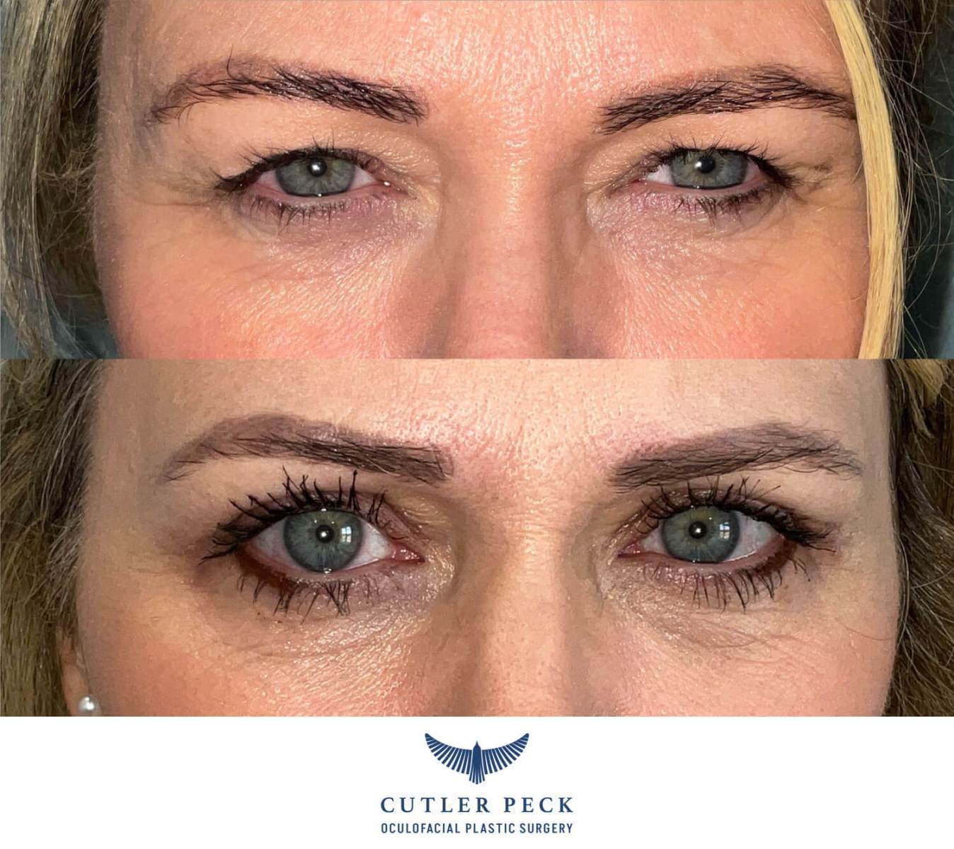 Female Bilateral Upper Eyelid Blepharoplasty | Dr. Cutler Peck