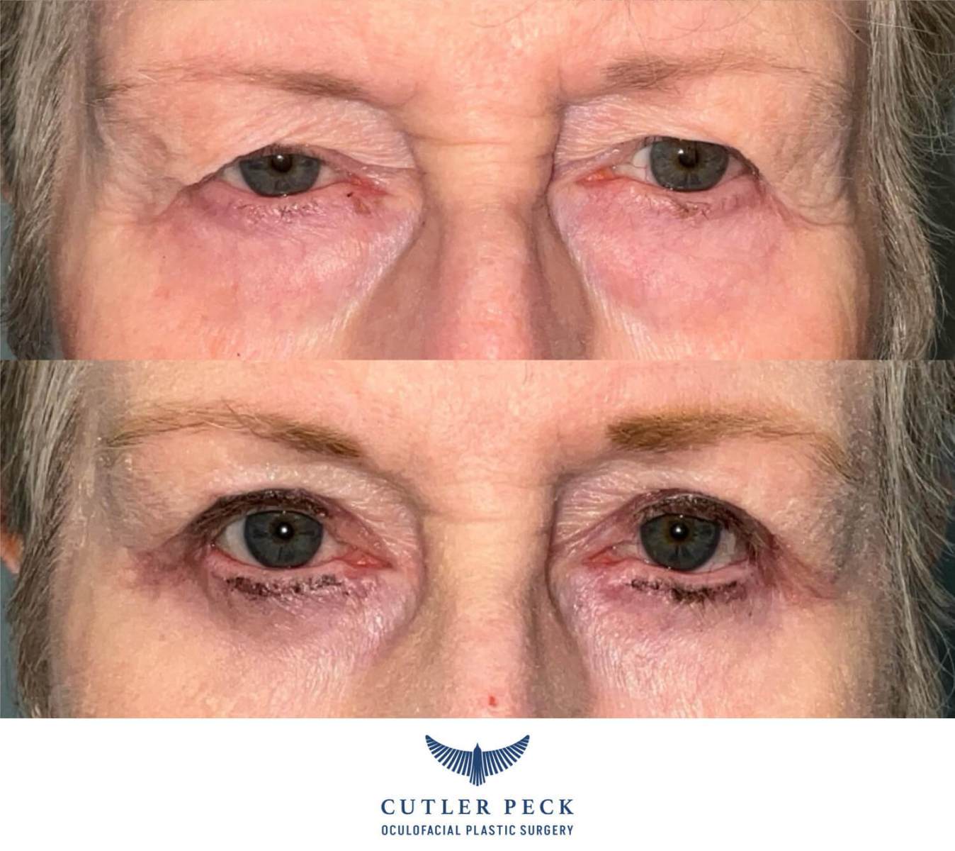 Female Bilateral Upper Eyelid Blepharoplasty | Dr. Cutler Peck