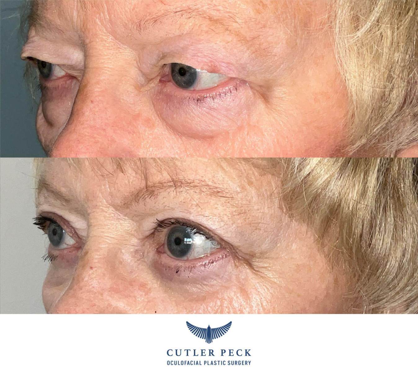 Female Bilateral Upper Eyelid Blepharoplasty | Dr. Cutler Peck