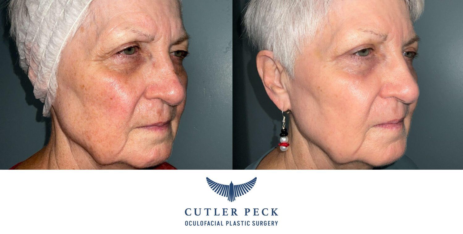 UltraClear Laser | Dr. Cutler Peck