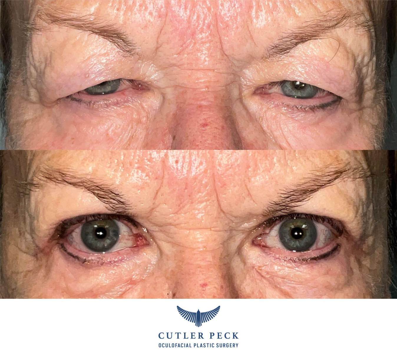 Female Bilateral Upper Eyelid Blepharoplasty | Dr. Cutler Peck