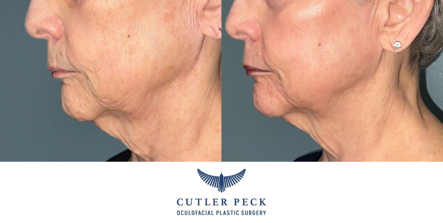 UltraClear Laser | Dr. Cutler Peck