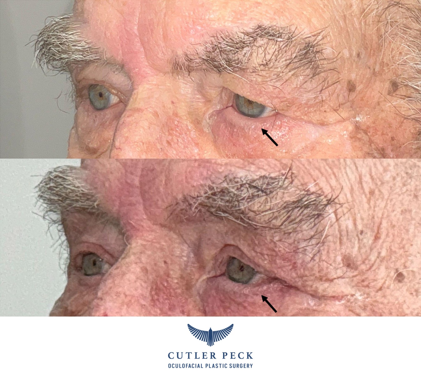 Ectropion Repair Lower Eyelids | Dr. Cutler Peck