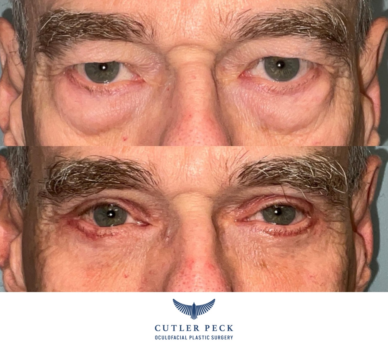 Male Bilateral Lower Eyelid Blepharoplasty | Dr. Cutler Peck