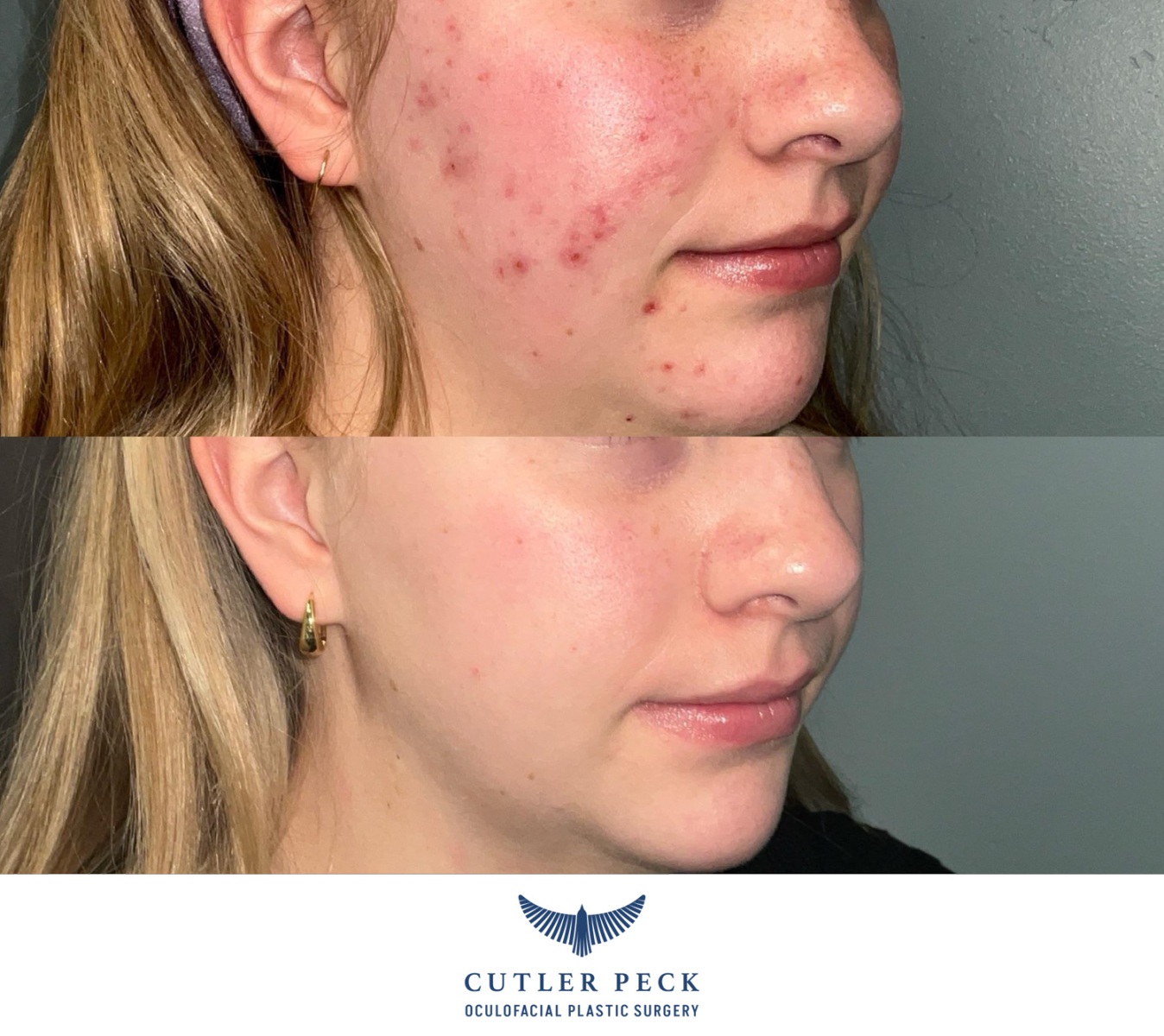 UltraClear Laser | Dr. Cutler Peck