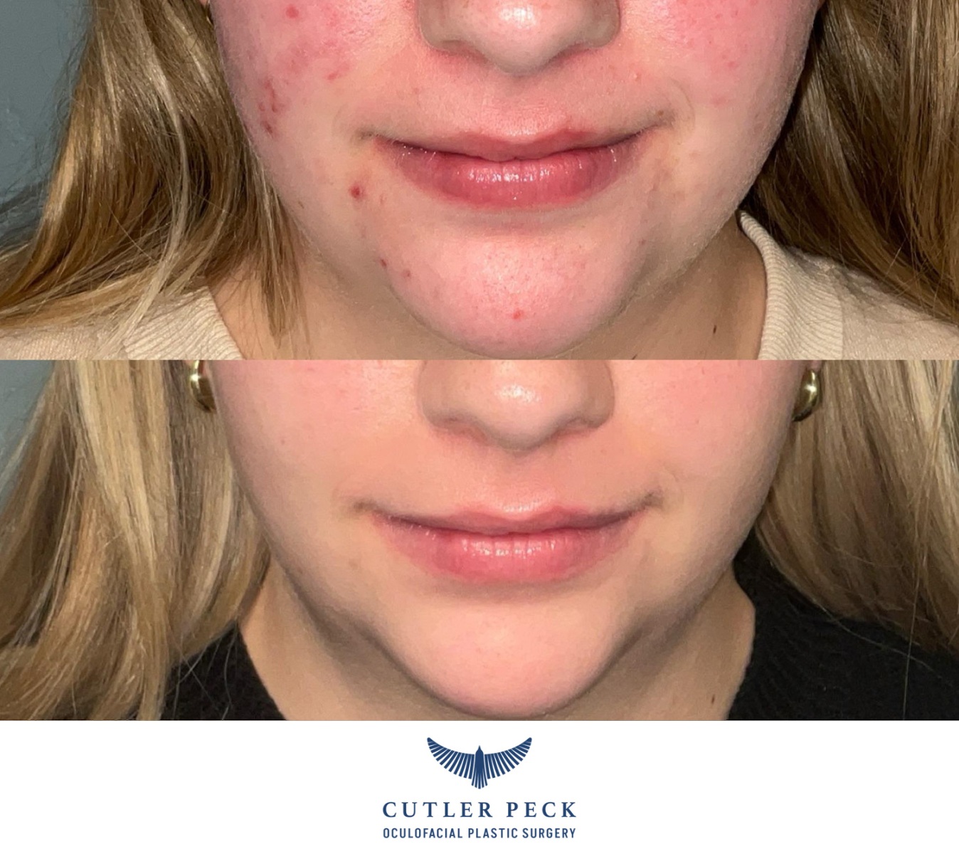 UltraClear Laser | Dr. Cutler Peck