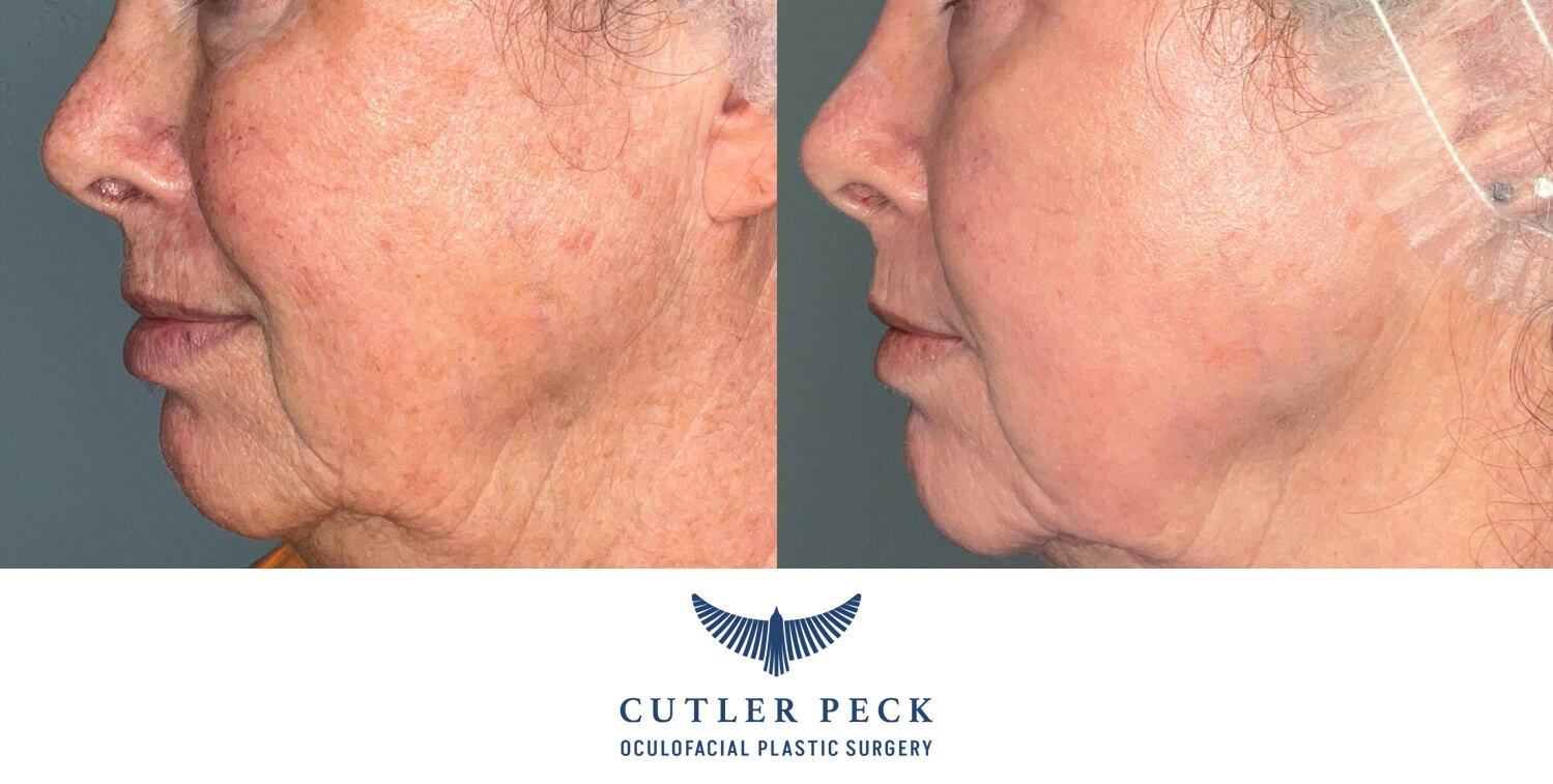Before and After Photo Gallery | Dr. Cutler Peck
