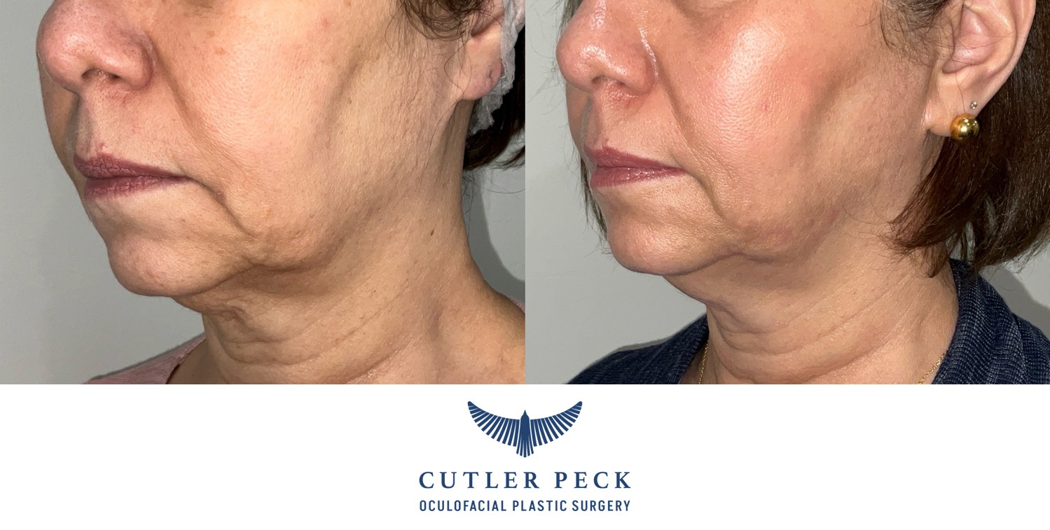 UltraClear Laser | Dr. Cutler Peck