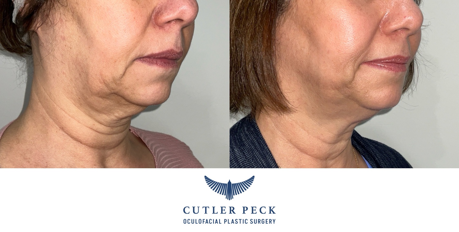 UltraClear Laser | Dr. Cutler Peck