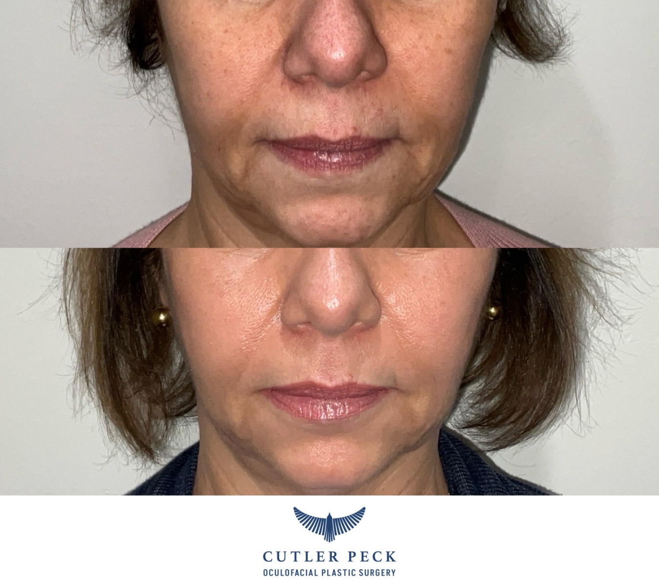 UltraClear Laser | Dr. Cutler Peck