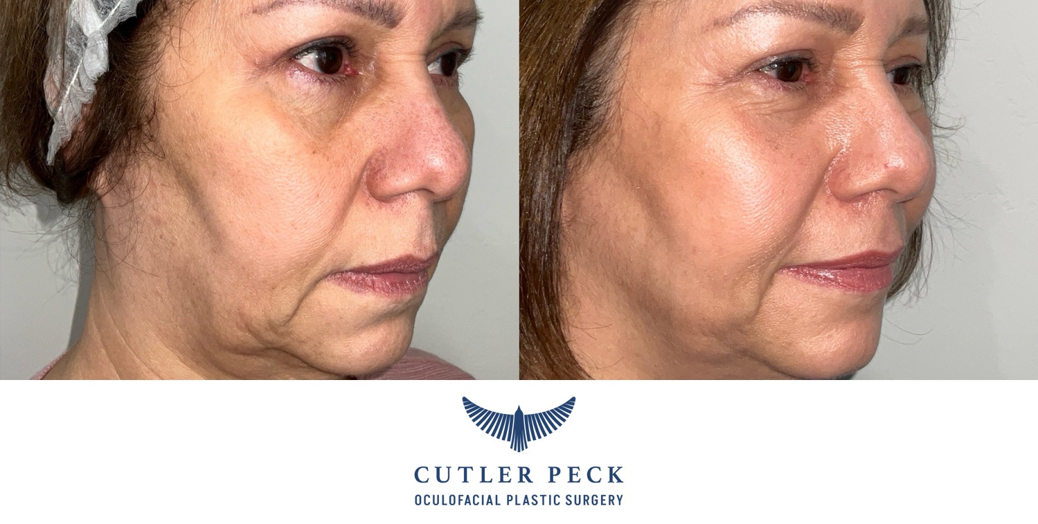UltraClear Laser | Dr. Cutler Peck