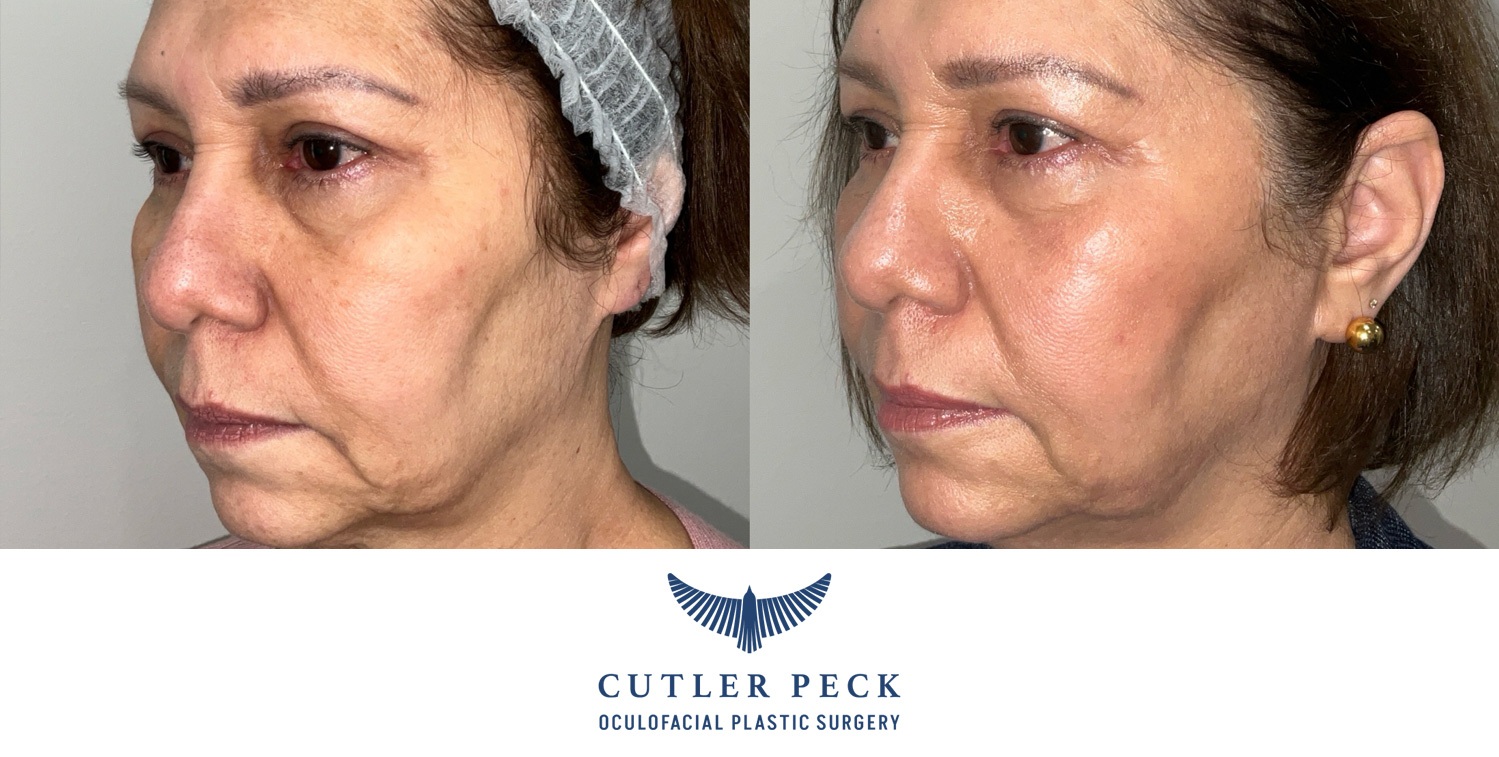 UltraClear Laser | Dr. Cutler Peck
