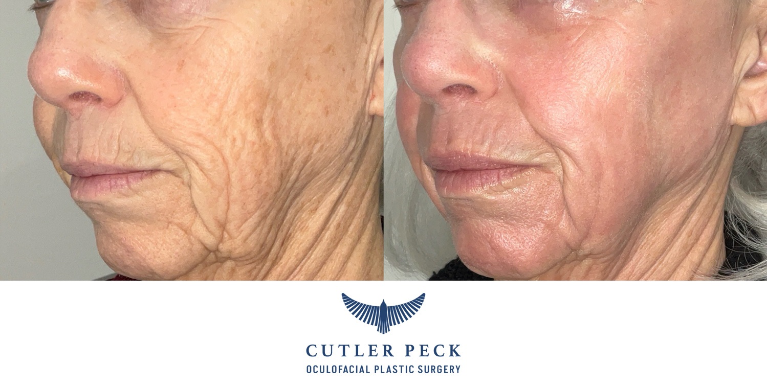 UltraClear Laser | Dr. Cutler Peck