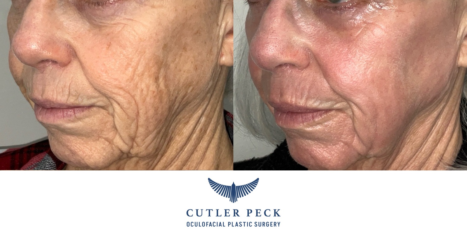 UltraClear Laser | Dr. Cutler Peck